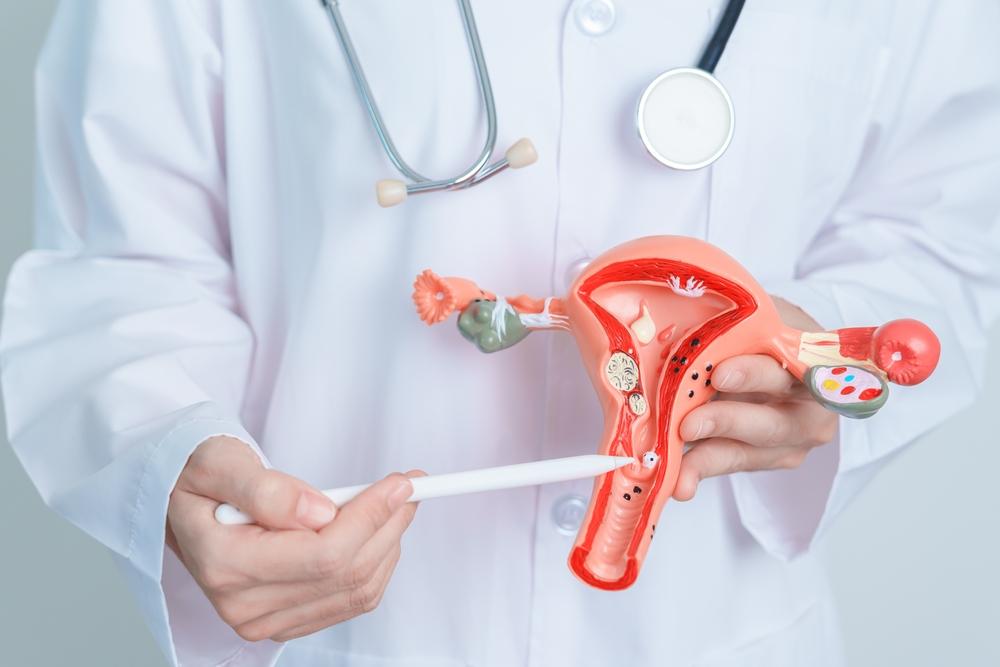 Pólipo do corpo do útero | O que é | Vida Saudável | Einstein Hospital ...